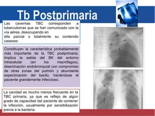 Tuberculosis pulmonar | PPTX
