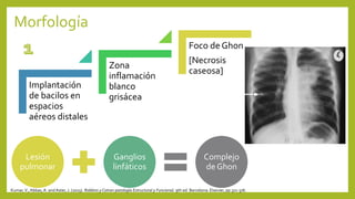 Tuberculosis 1 | PDF