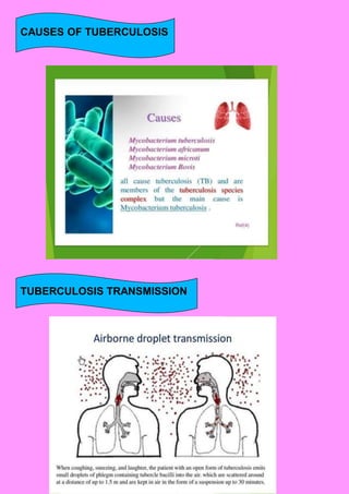 Tuberculosis | PDF