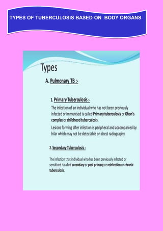 Tuberculosis | PDF