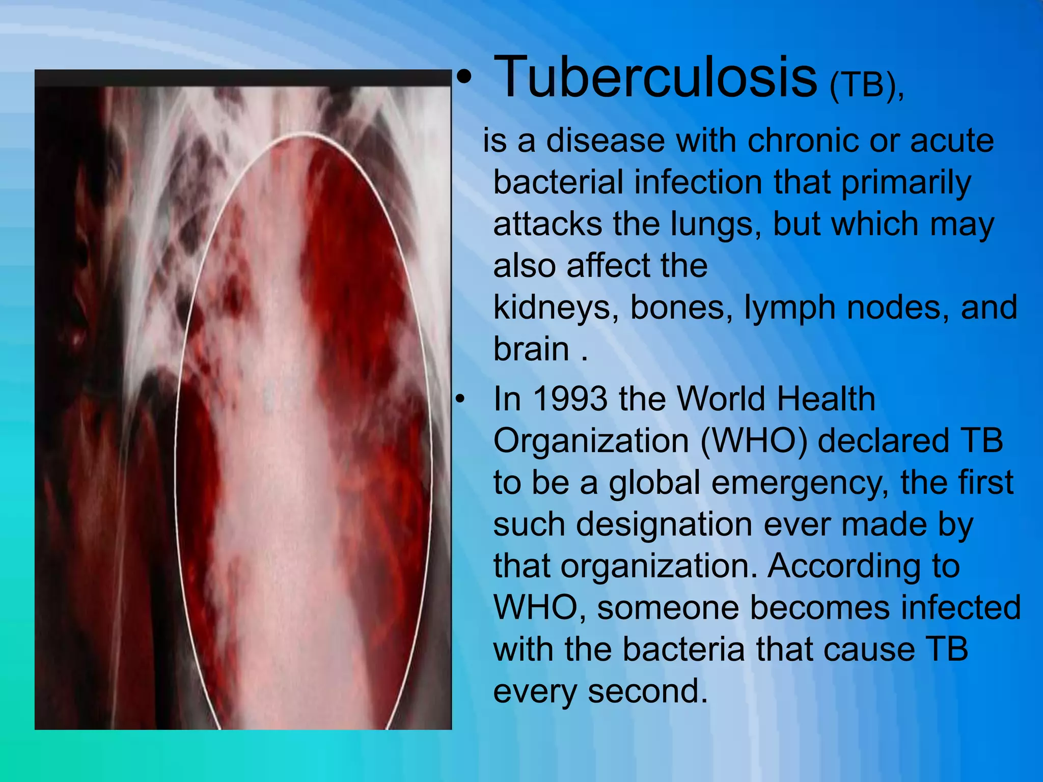 Tuberculosis | PPTX