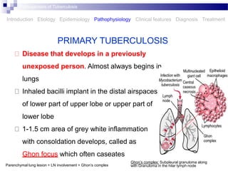 tuberculosis .pptx