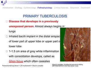 tuberculosis (2).pptx