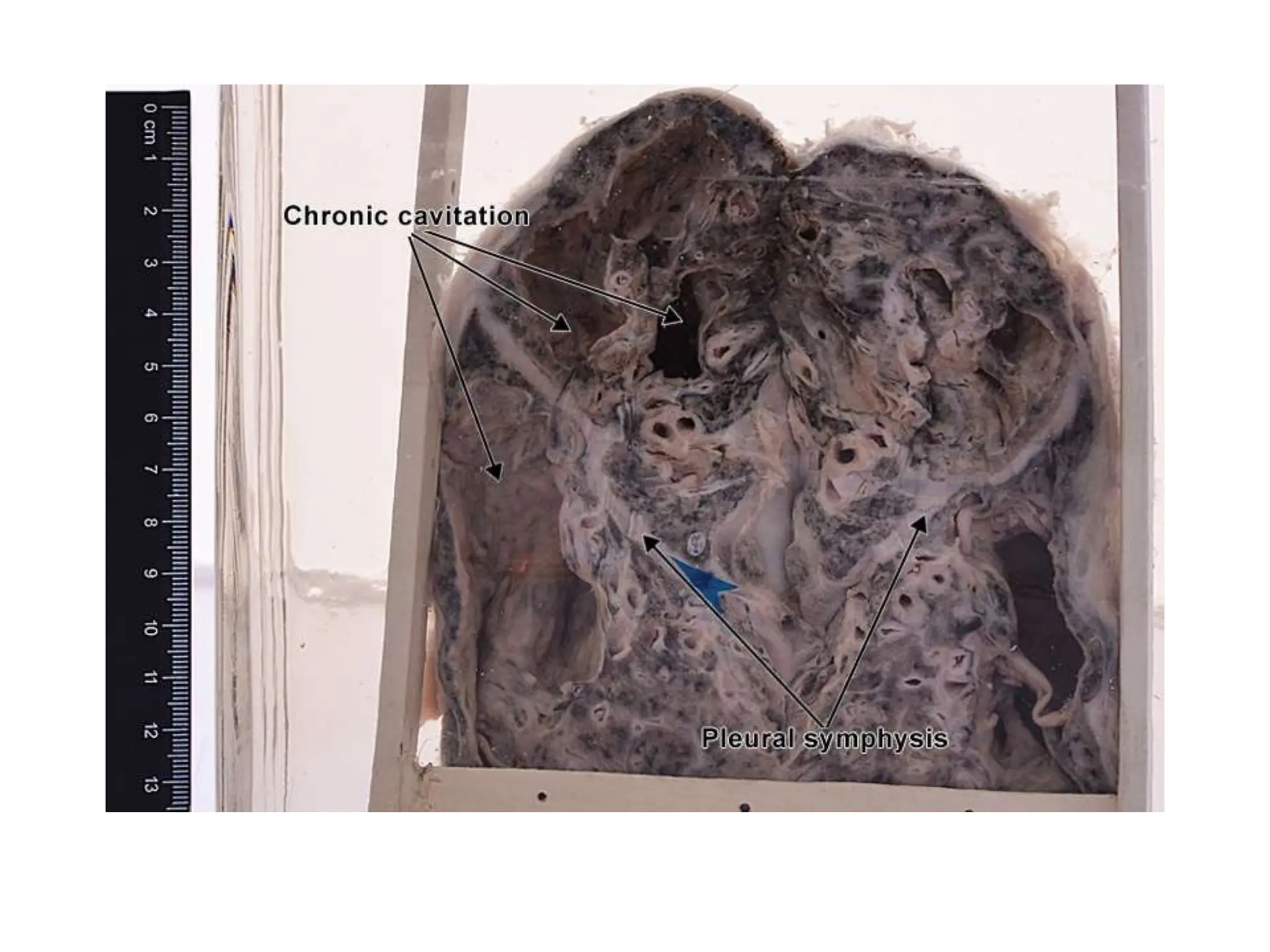 Pathology: Tuberculosis - lectures-.pptx