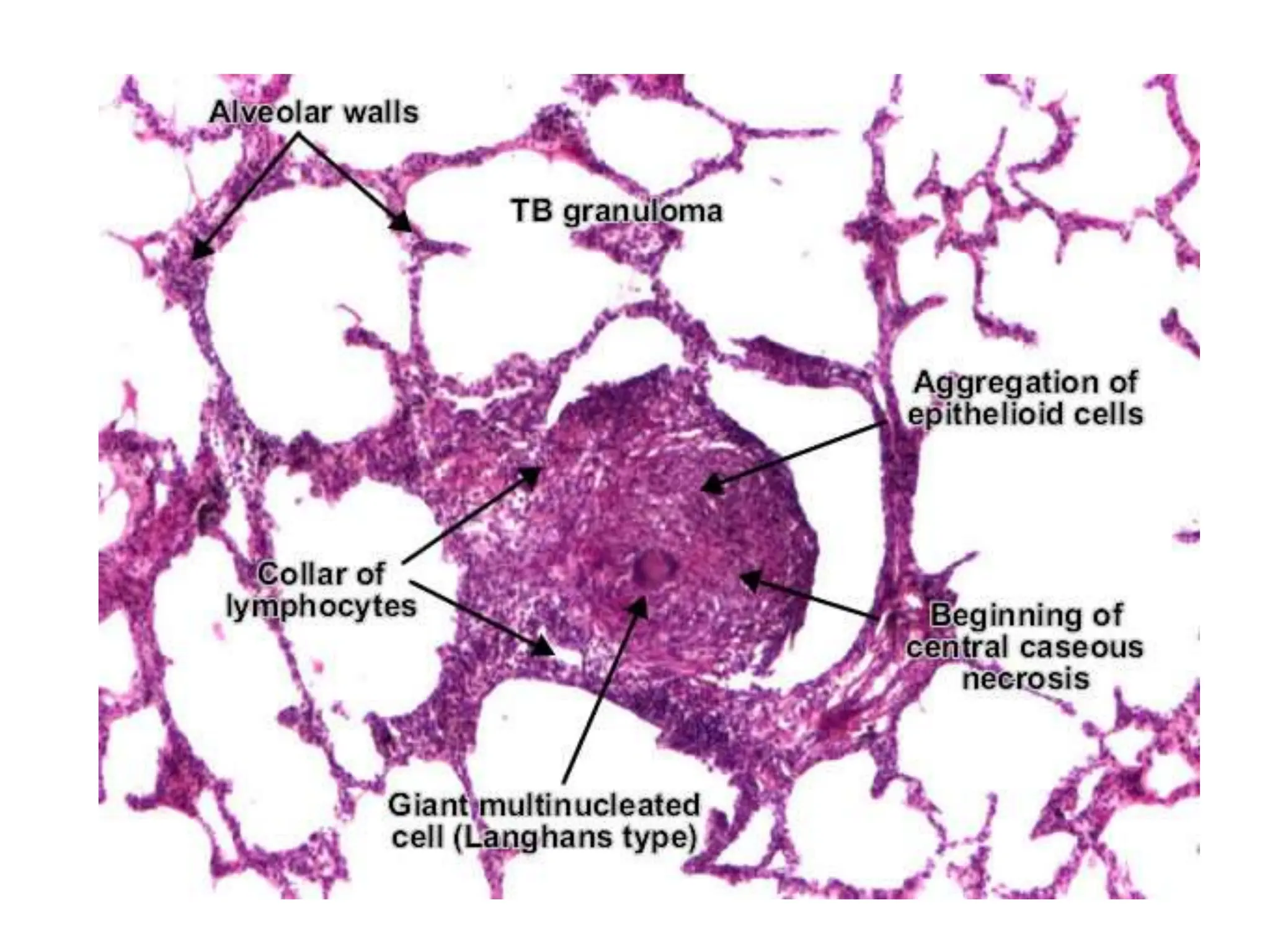 Pathology: Tuberculosis - lectures-.pptx