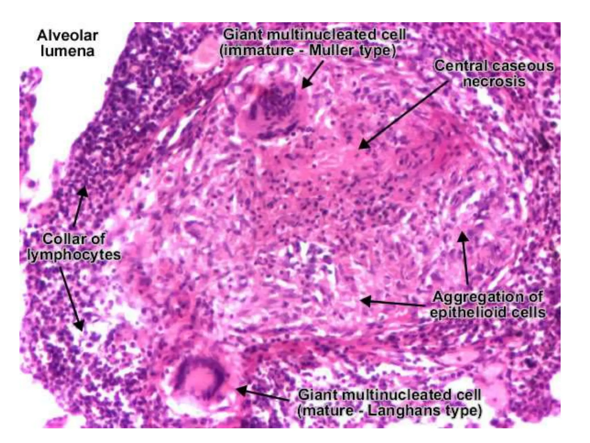 Pathology: Tuberculosis - lectures-.pptx