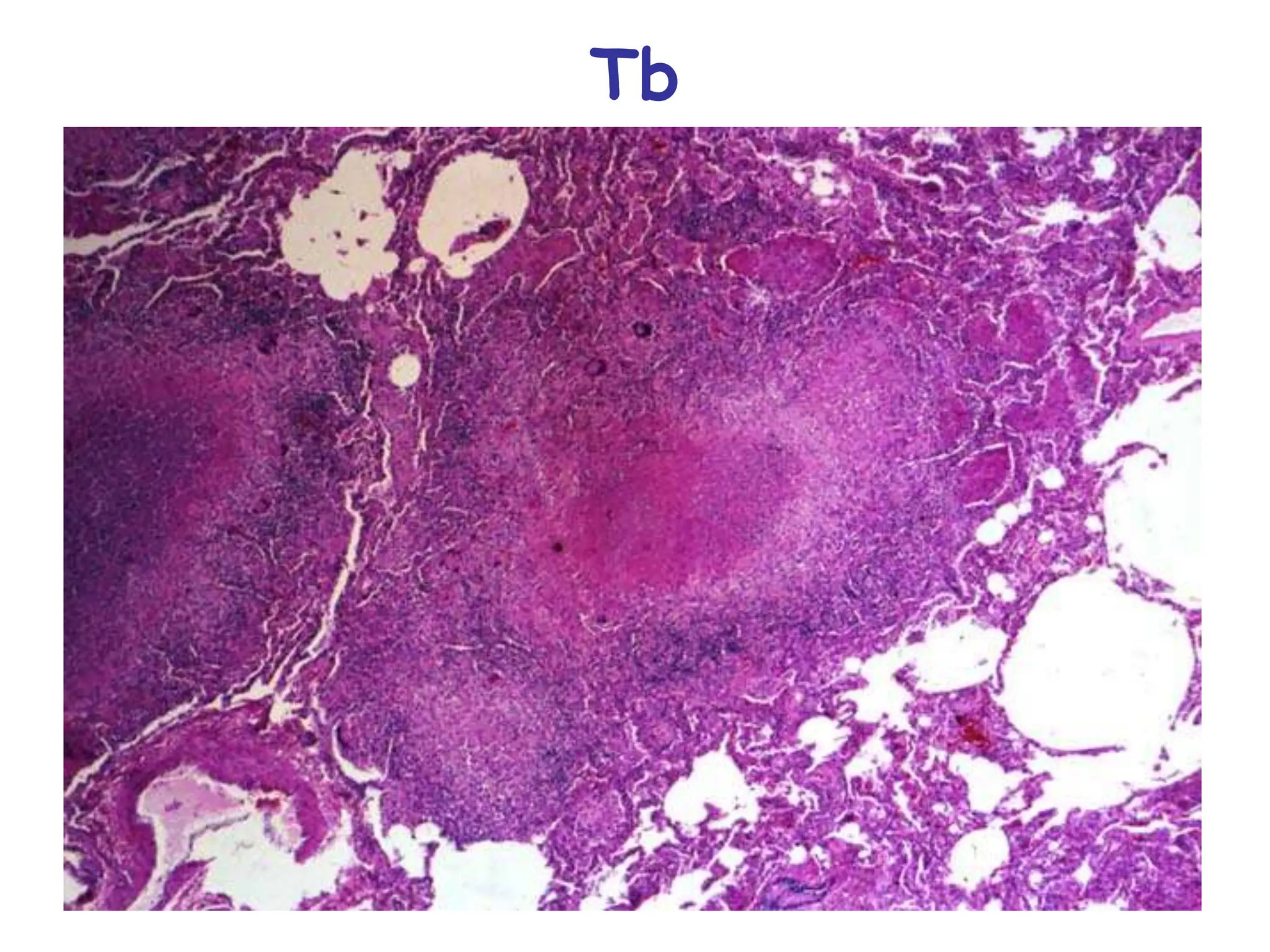 Pathology: Tuberculosis - lectures-.pptx