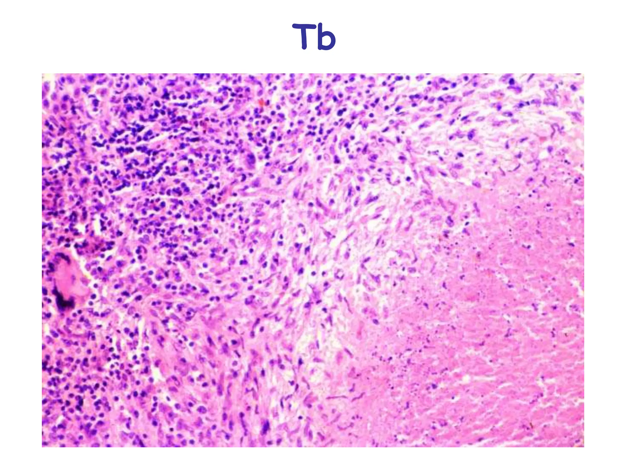 Pathology: Tuberculosis - lectures-.pptx