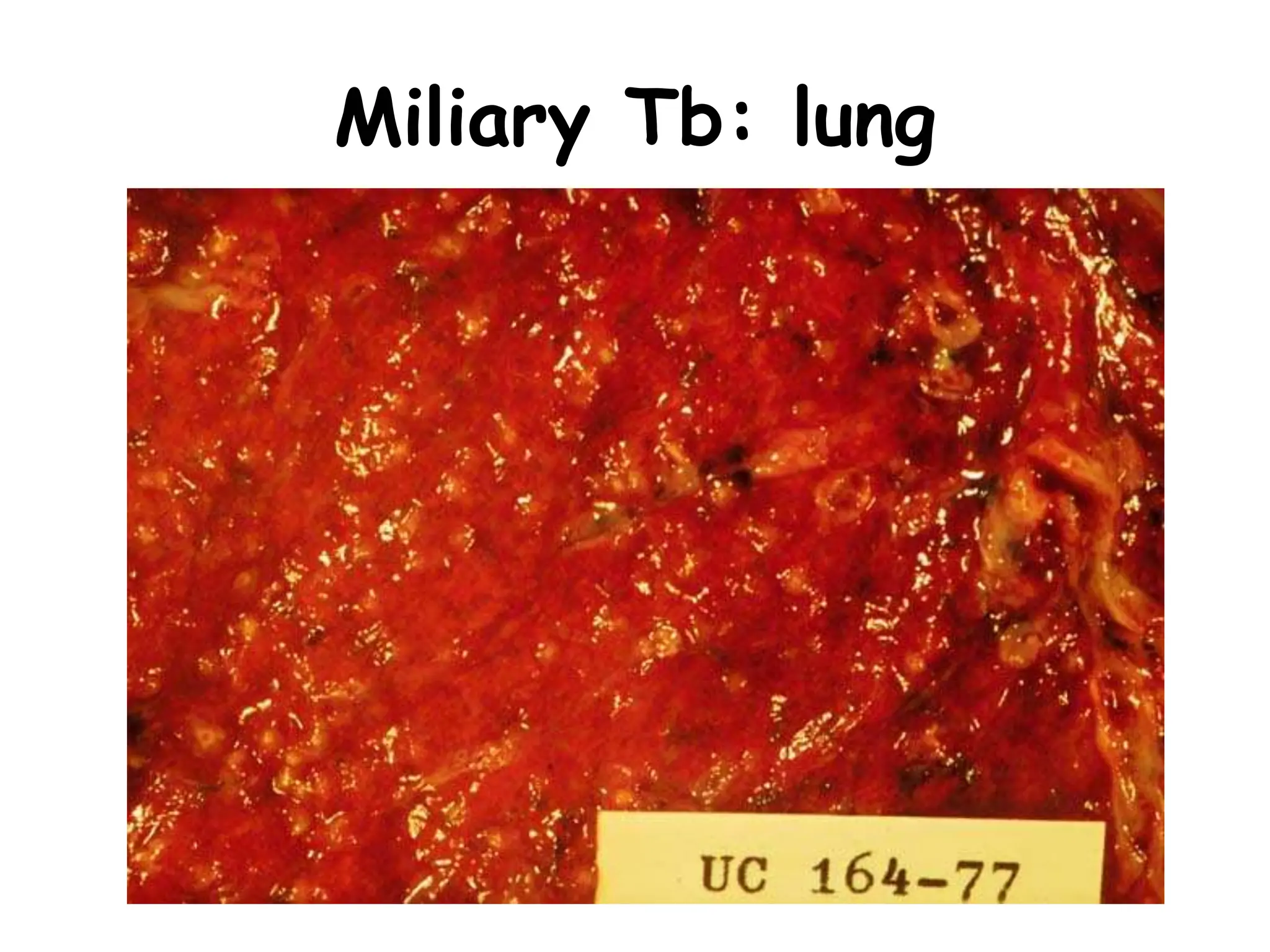 Pathology: Tuberculosis - lectures-.pptx