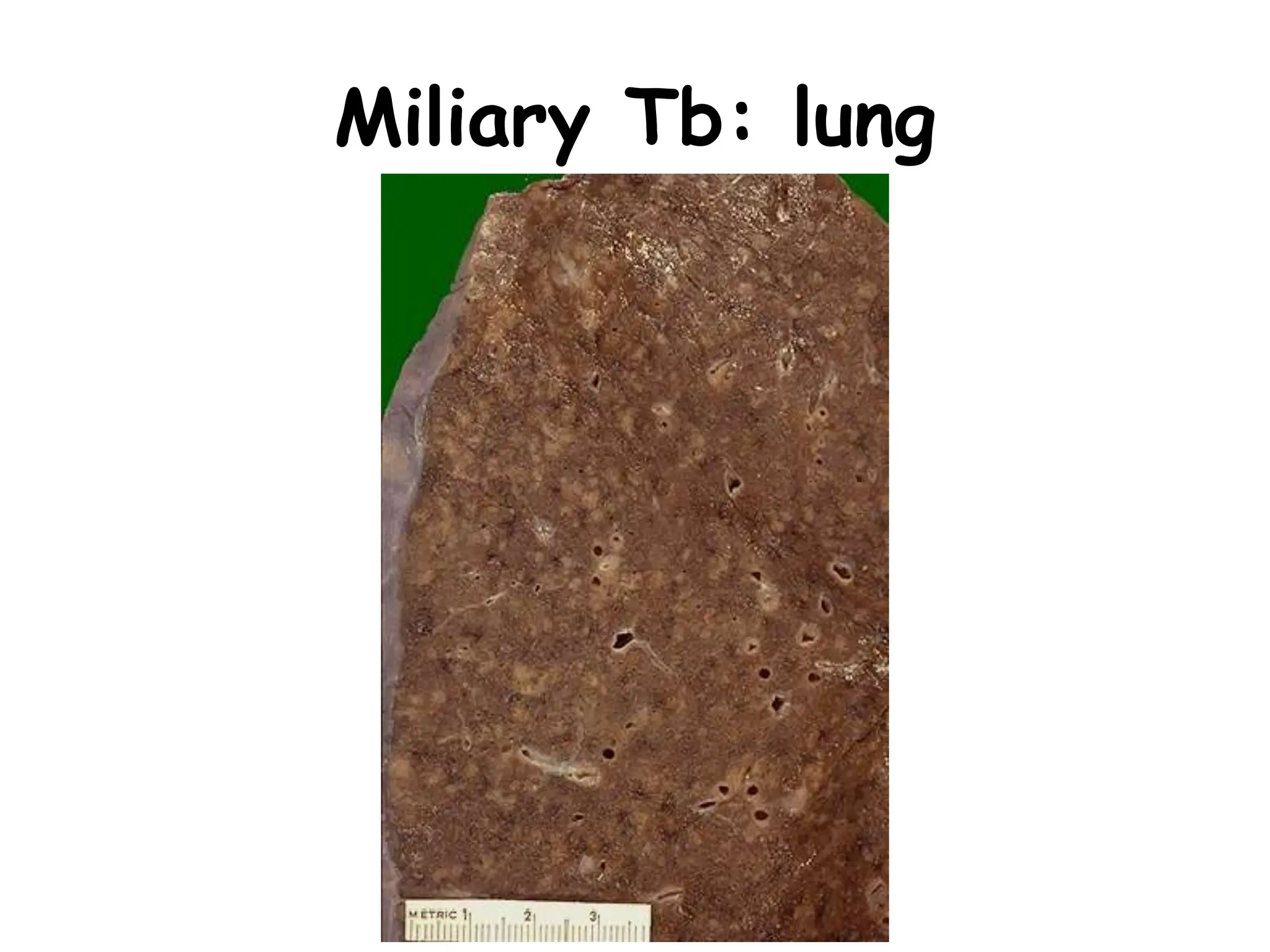 Pathology: Tuberculosis - lectures-.pptx