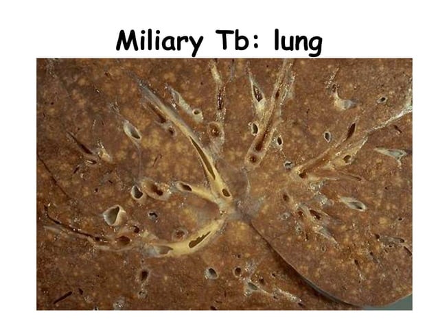 Pathology: Tuberculosis - lectures-.pptx
