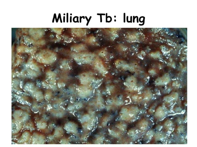 Pathology: Tuberculosis - lectures-.pptx