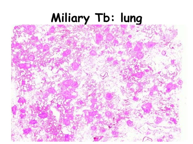 Pathology: Tuberculosis - lectures-.pptx