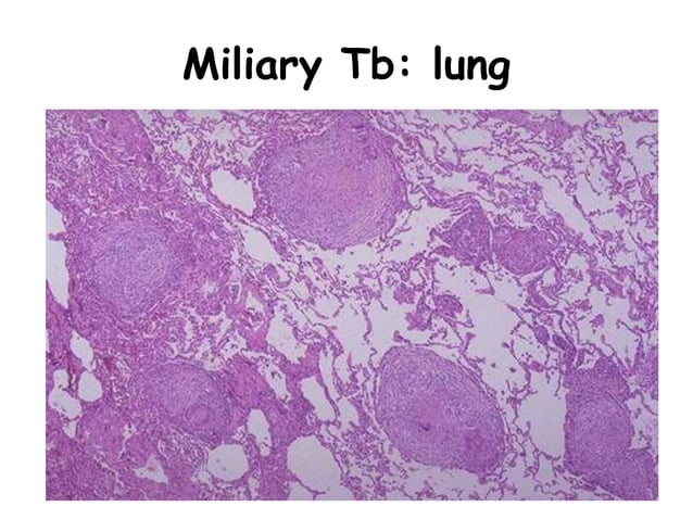 Pathology: Tuberculosis - lectures-.pptx