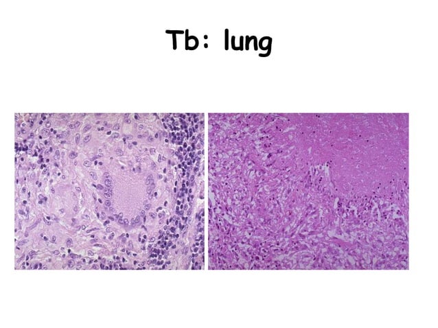 Pathology: Tuberculosis - lectures-.pptx