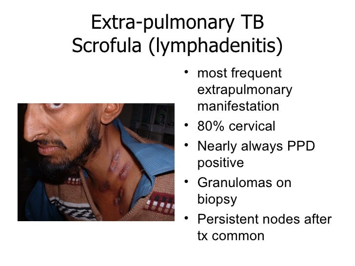 Tuberculosis and Leprosy