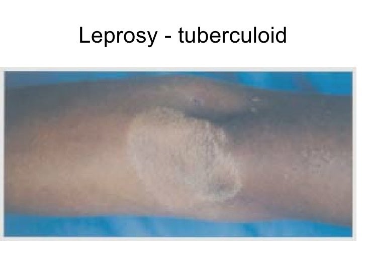 Tuberculosis and Leprosy