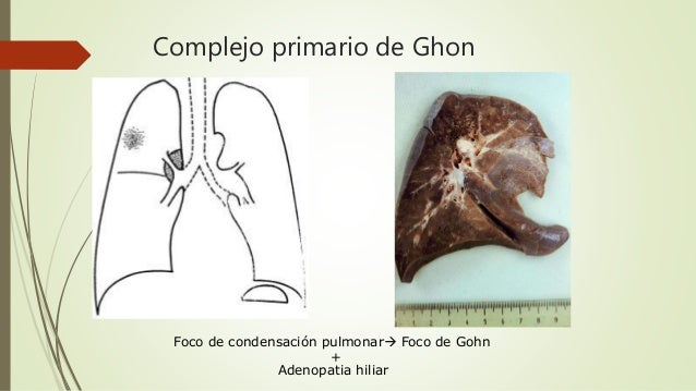 Tuberculosis Guia Minsal Chile, Universidad Mayor, 2016