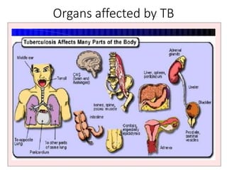 TUBERCULOSIS | PPTX
