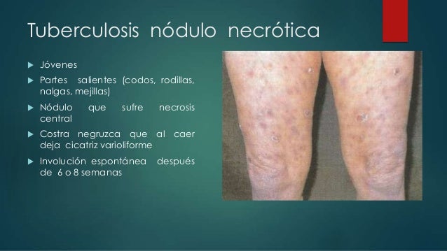 Lesoes Cutaneas Tuberculosas