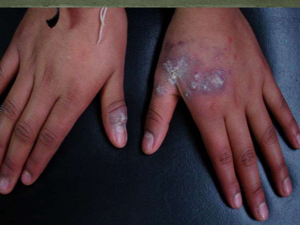 Tuberculosis cutanea 2