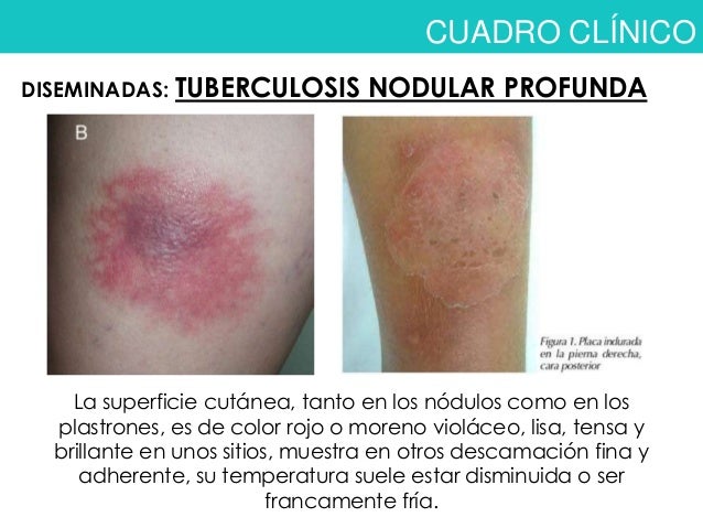 Lesoes Cutaneas Tuberculosas