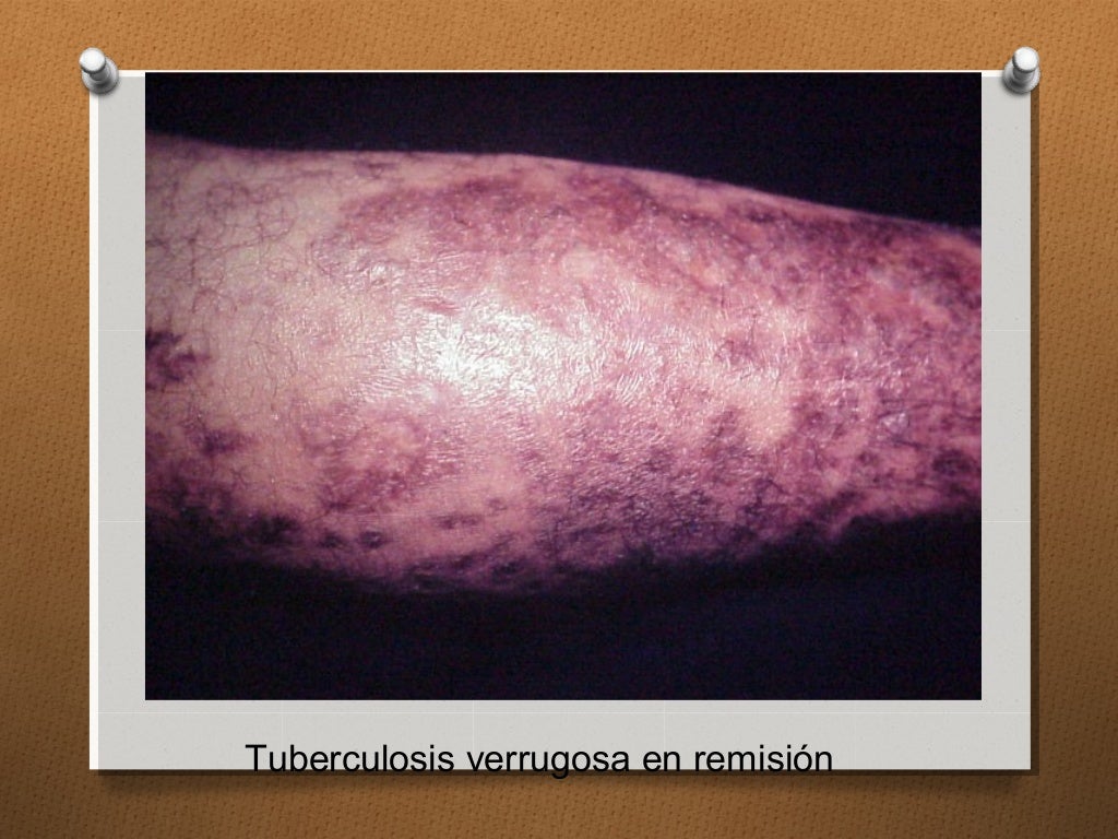 Tuberculosis cutanea