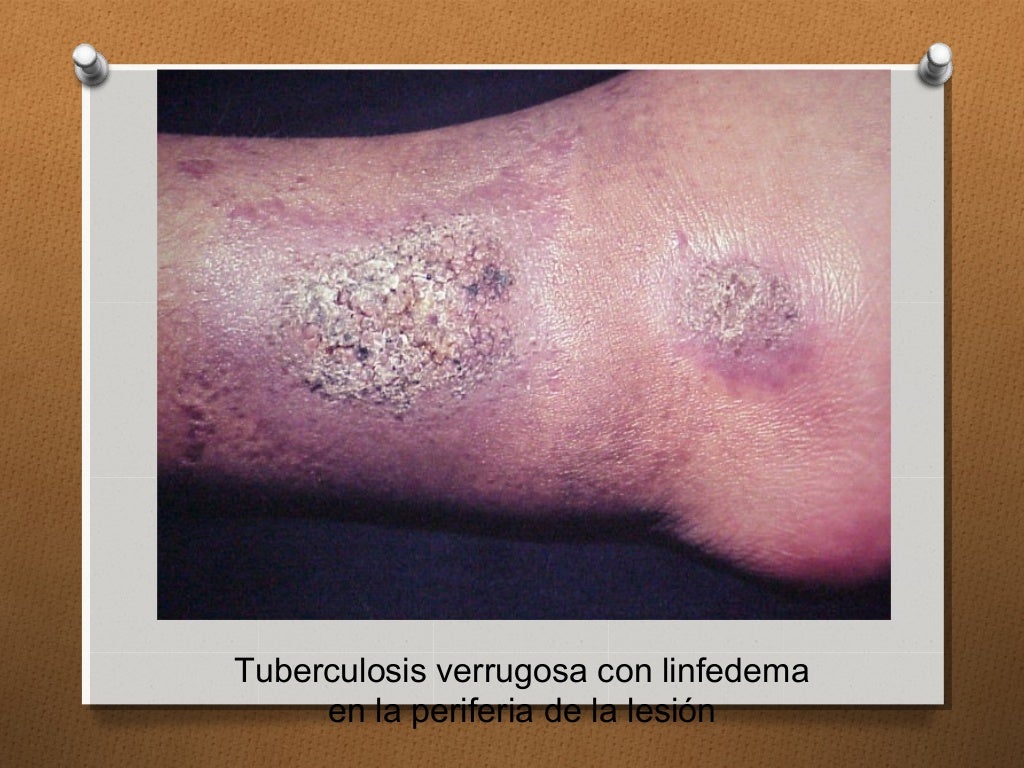 Tuberculosis Cutanea