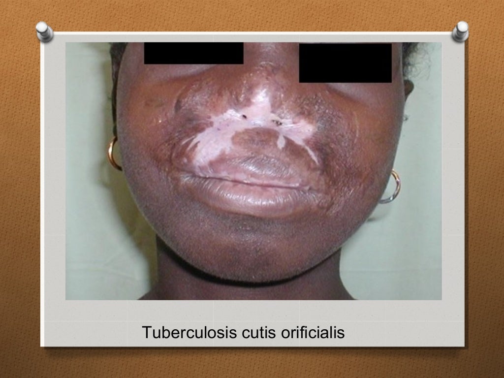 Tuberculosis cutanea