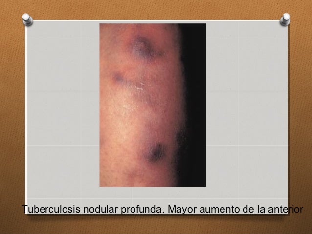 Tuberculosis cutanea