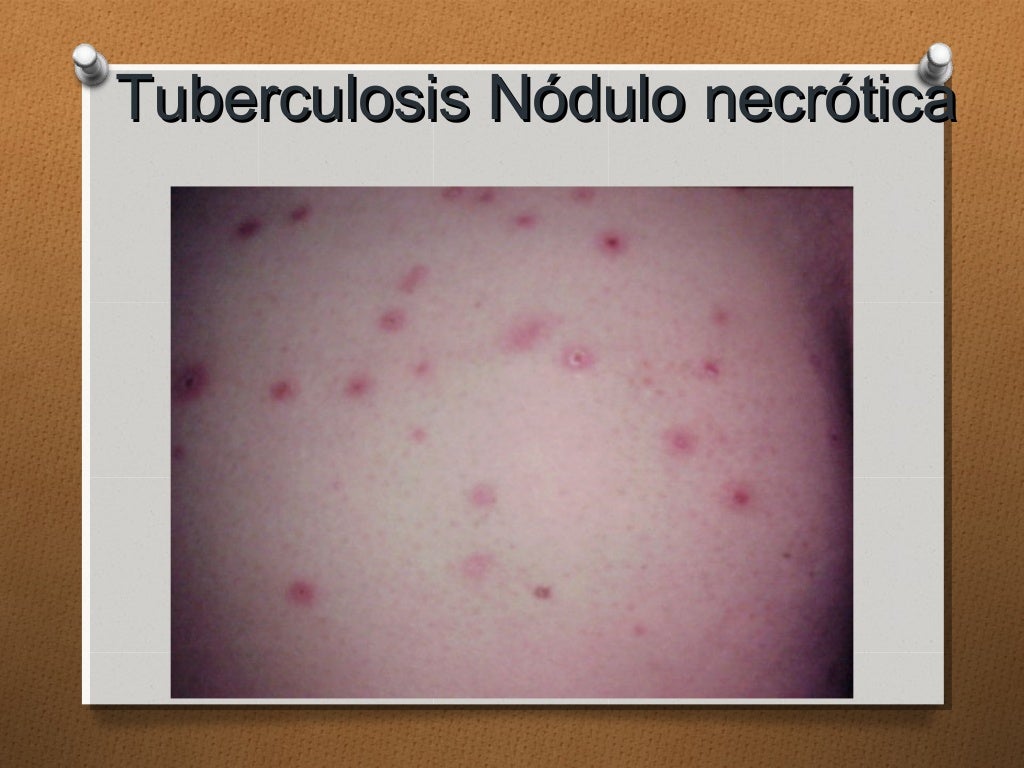 Tuberculosis Cutanea