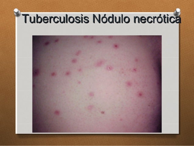 Tuberculosis cutanea