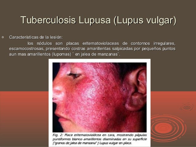 Tuberculosis cutaneas