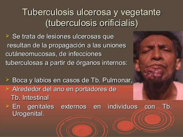 Tuberculosis cutaneas