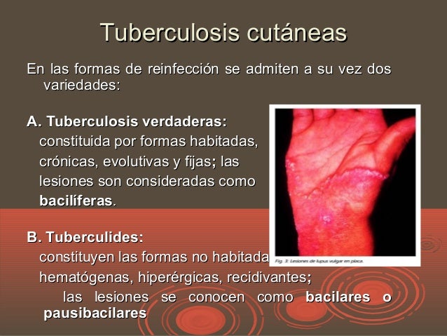 Tuberculosis cutaneas