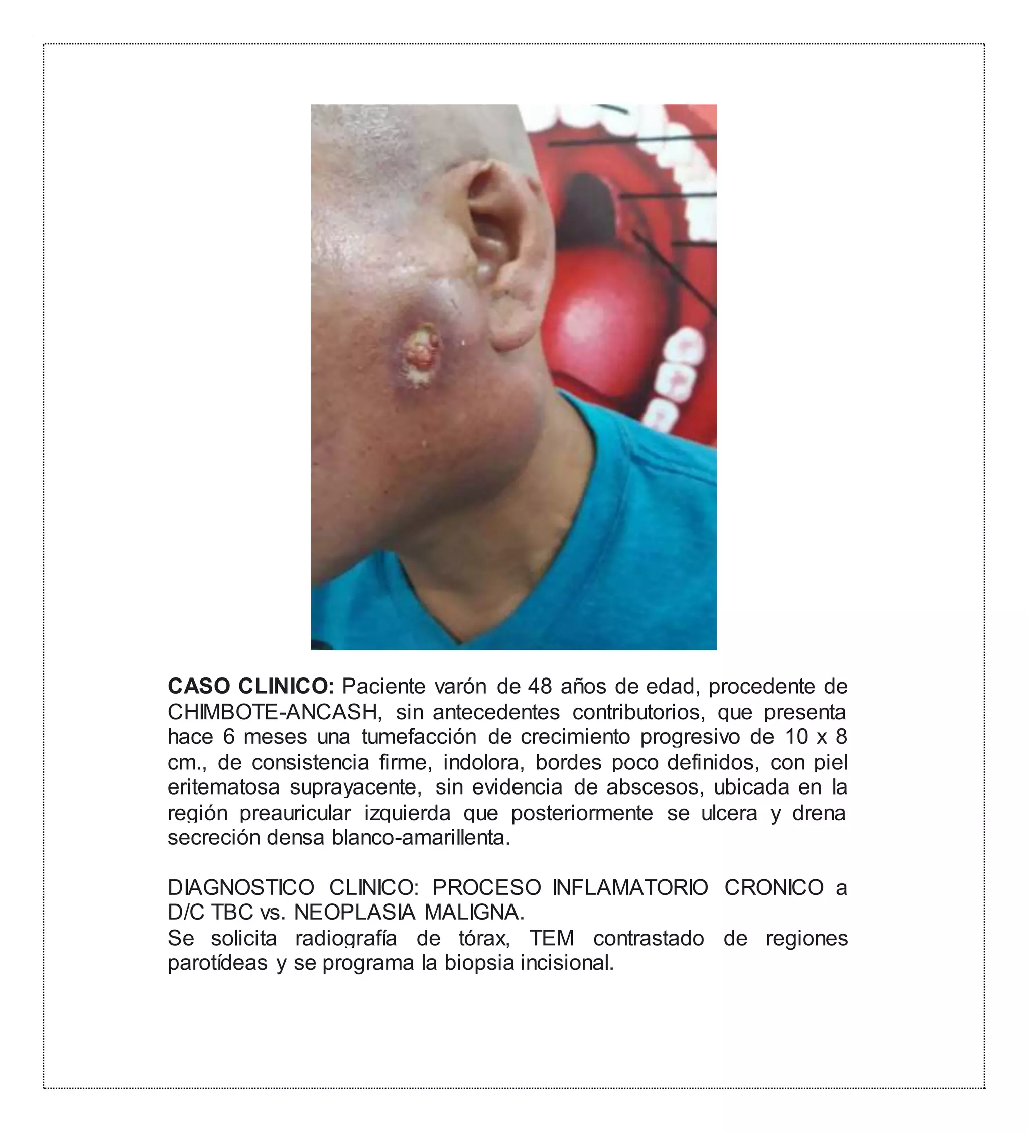TUBERCULOSIS DE LA GLANDULA PAROTIDA | DOCX