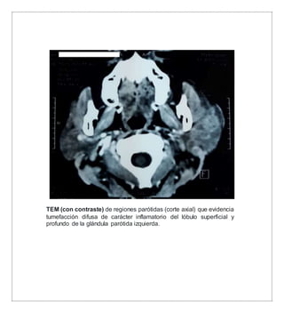 TUBERCULOSIS DE LA GLANDULA PAROTIDA | DOCX