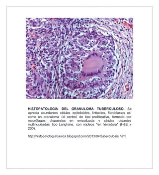 TUBERCULOSIS DE LA GLANDULA PAROTIDA | DOCX