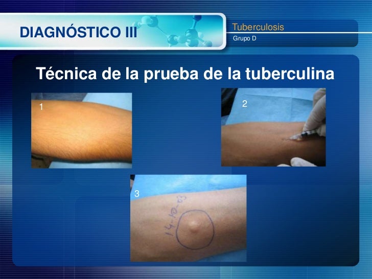 Tuberculosis