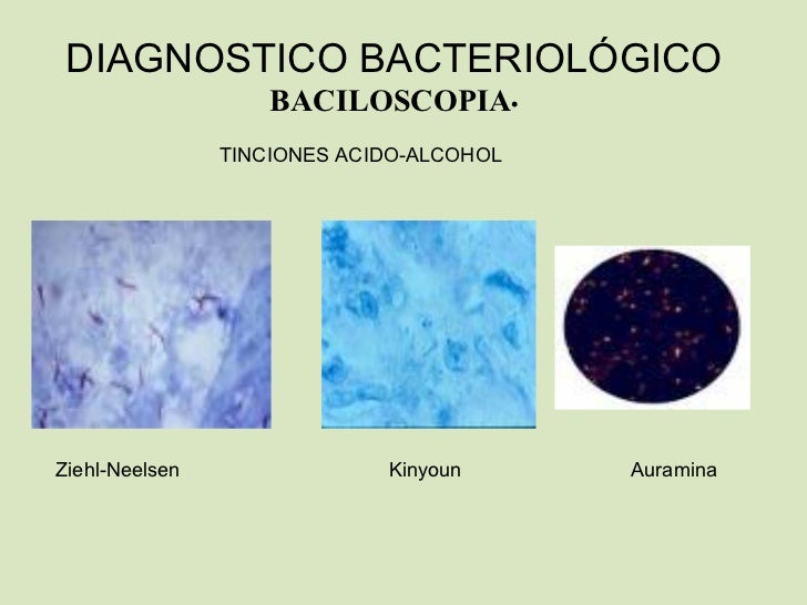 Tuberculosis e interpretación de bk
