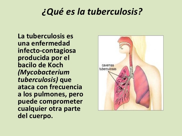 Tuberculosis e interpretación de bk