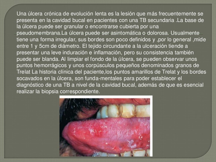 Tuberculosis en cavidad oral