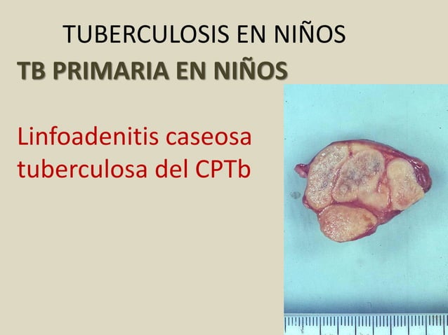 Tuberculosis en niños 2017 | PPT
