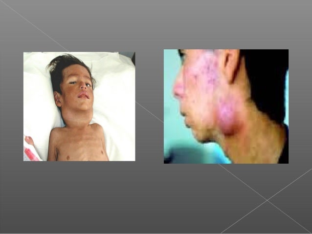 Tuberculosis en pediatria