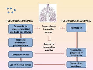 Tuberculosis exposicion | PPT
