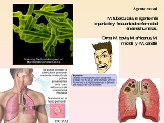 Tuberculosis exposicion | PPT