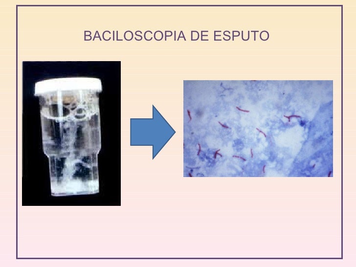 Tuberculosis exposicion