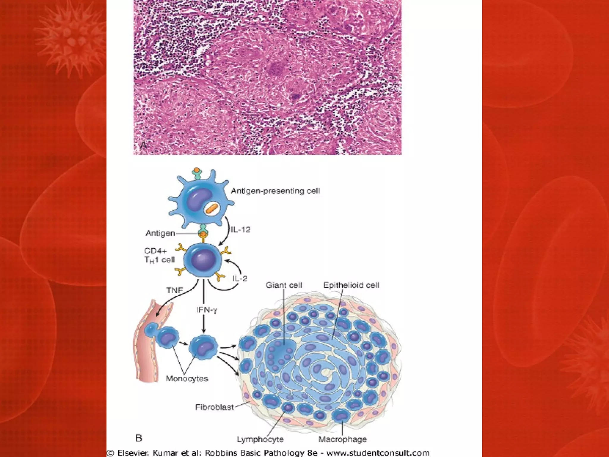 Tuberculosis (extra pulmonary) | PPT
