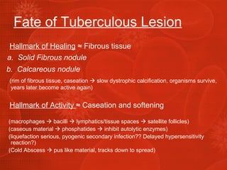 Tuberculosis (extra pulmonary) | PPT