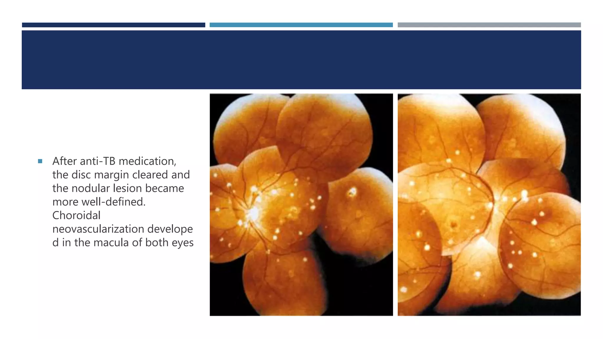Ocular Manifestations of Tuberculosis | PPTX